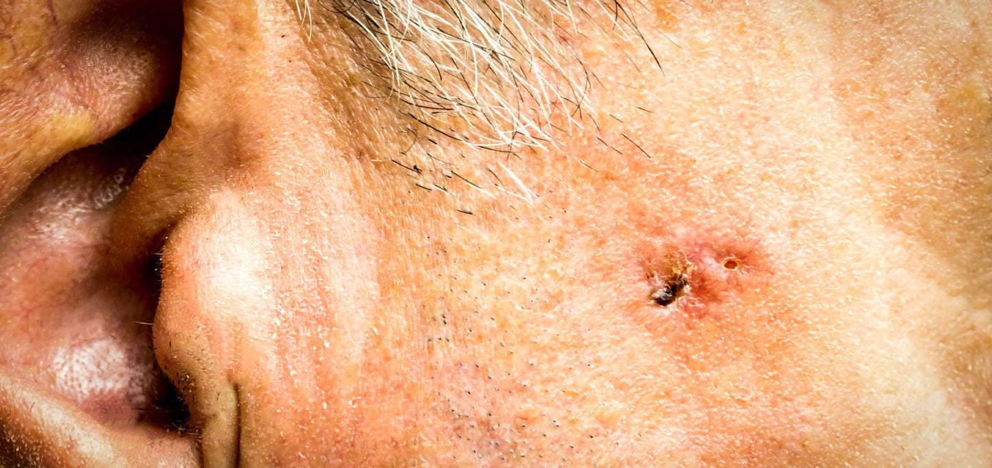 Treating Basal Cell Carcinoma Cambridge The Day Clinic