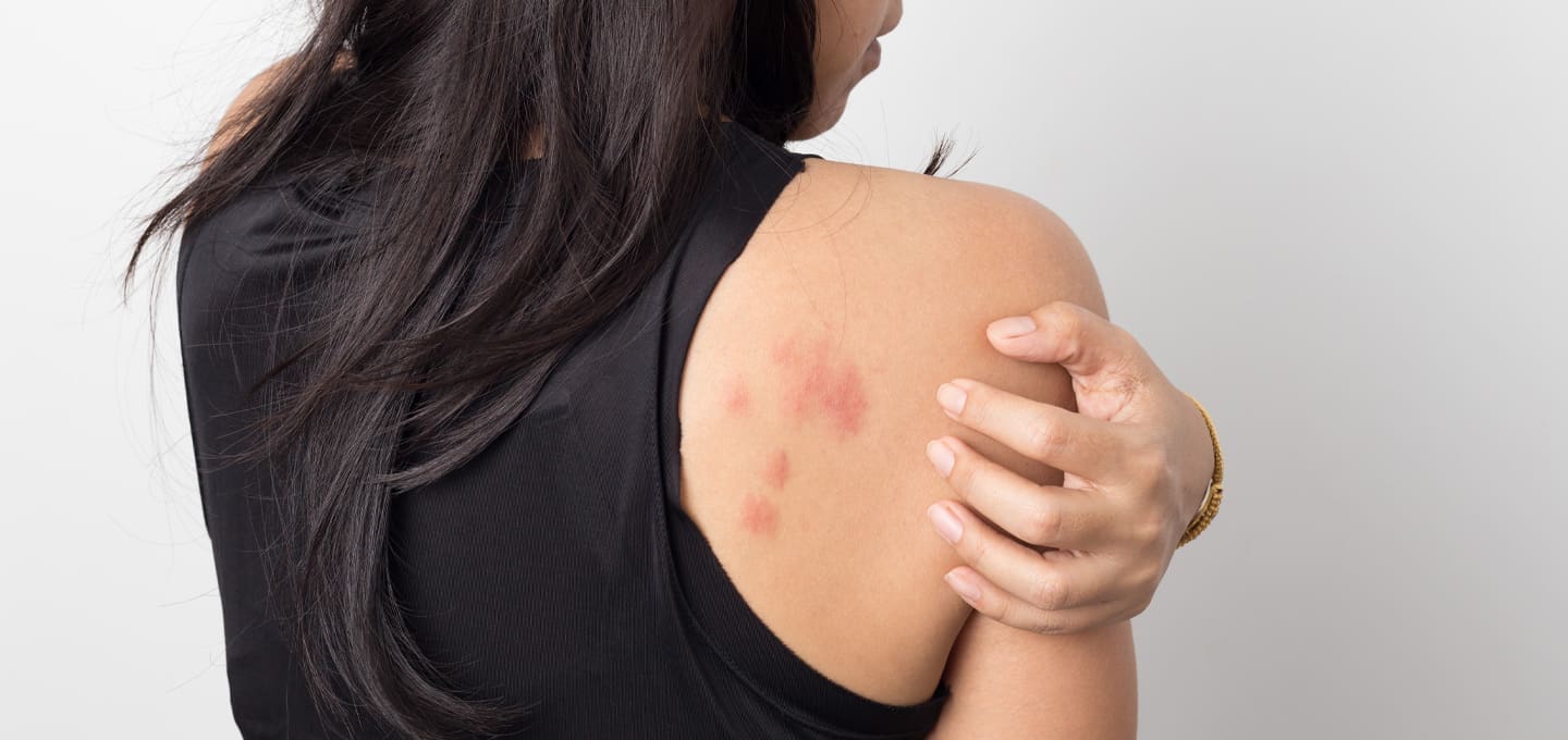 Treatment Of Urticaria In Cambridge At The Day Clinic