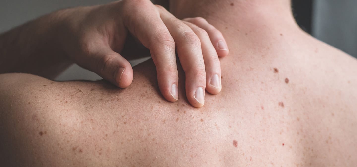 Surgical Excision | The Day Clinic | Dr Ahid Abood