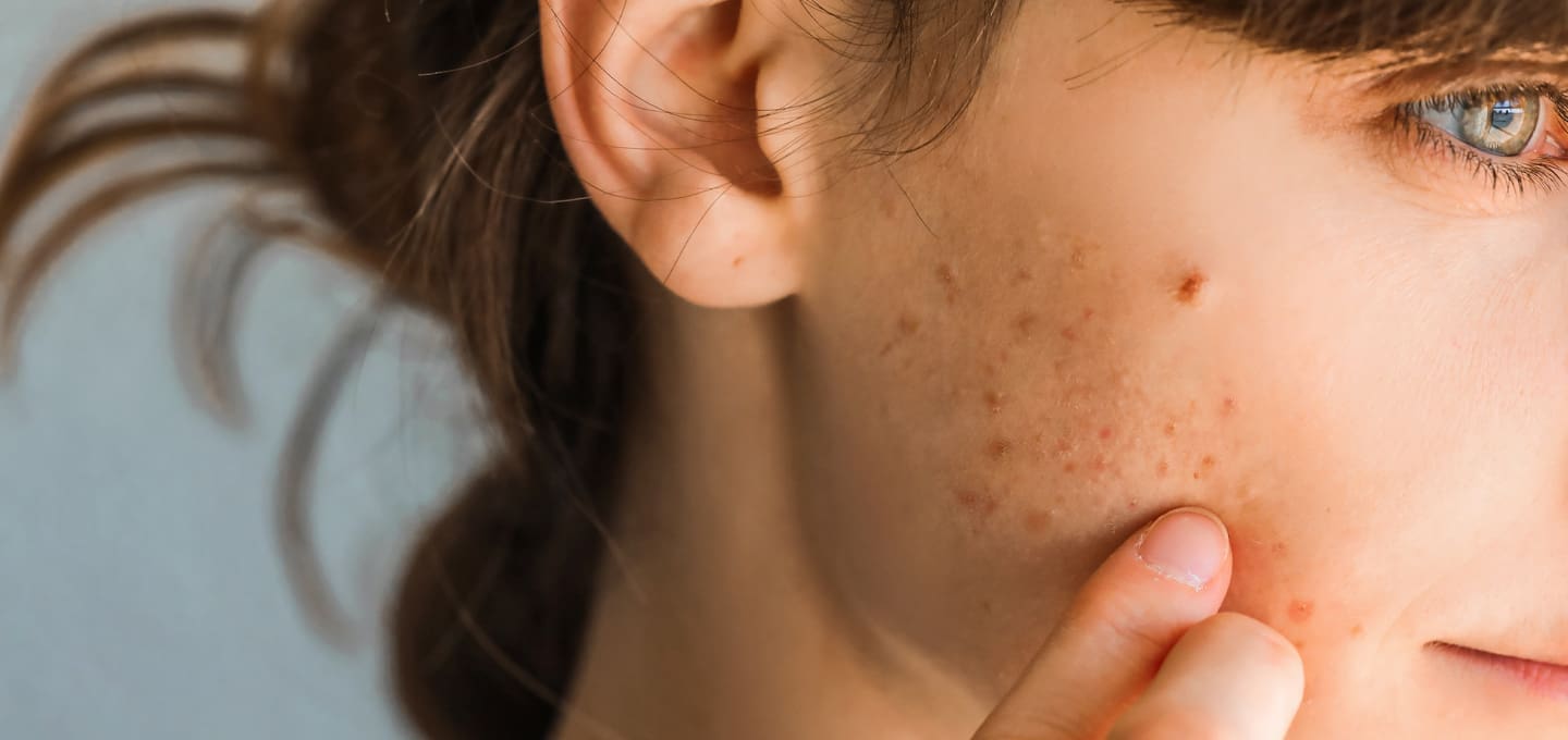 Acne | Diagnosis and Effective Treatment | The Day Clinic