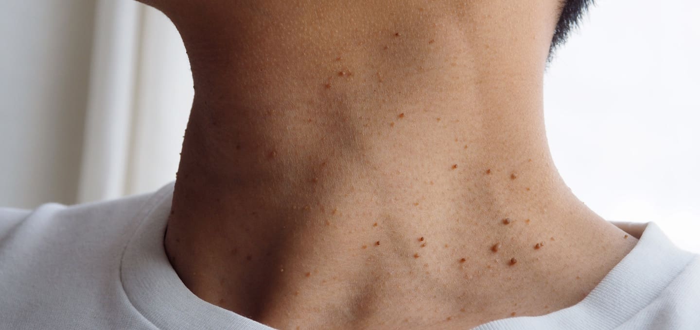 Shave Excision Cambridge The Day Clinic Ahid Abood