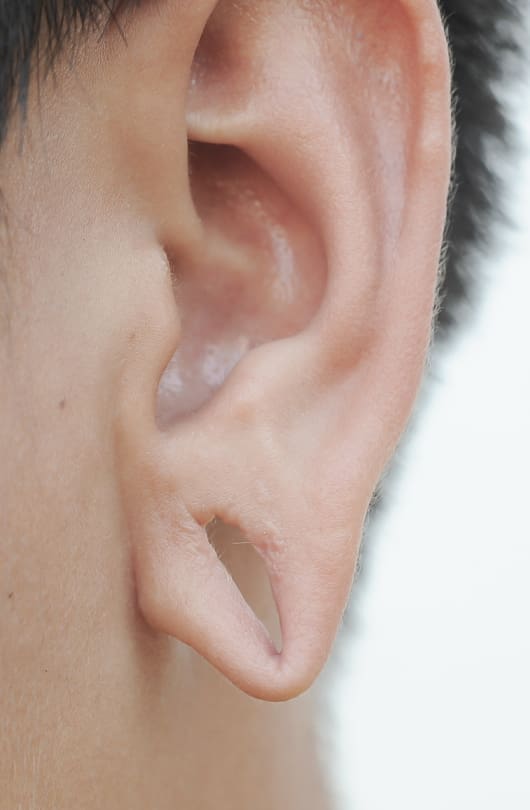 Split Earlobes | Conditions | The Day Clinic