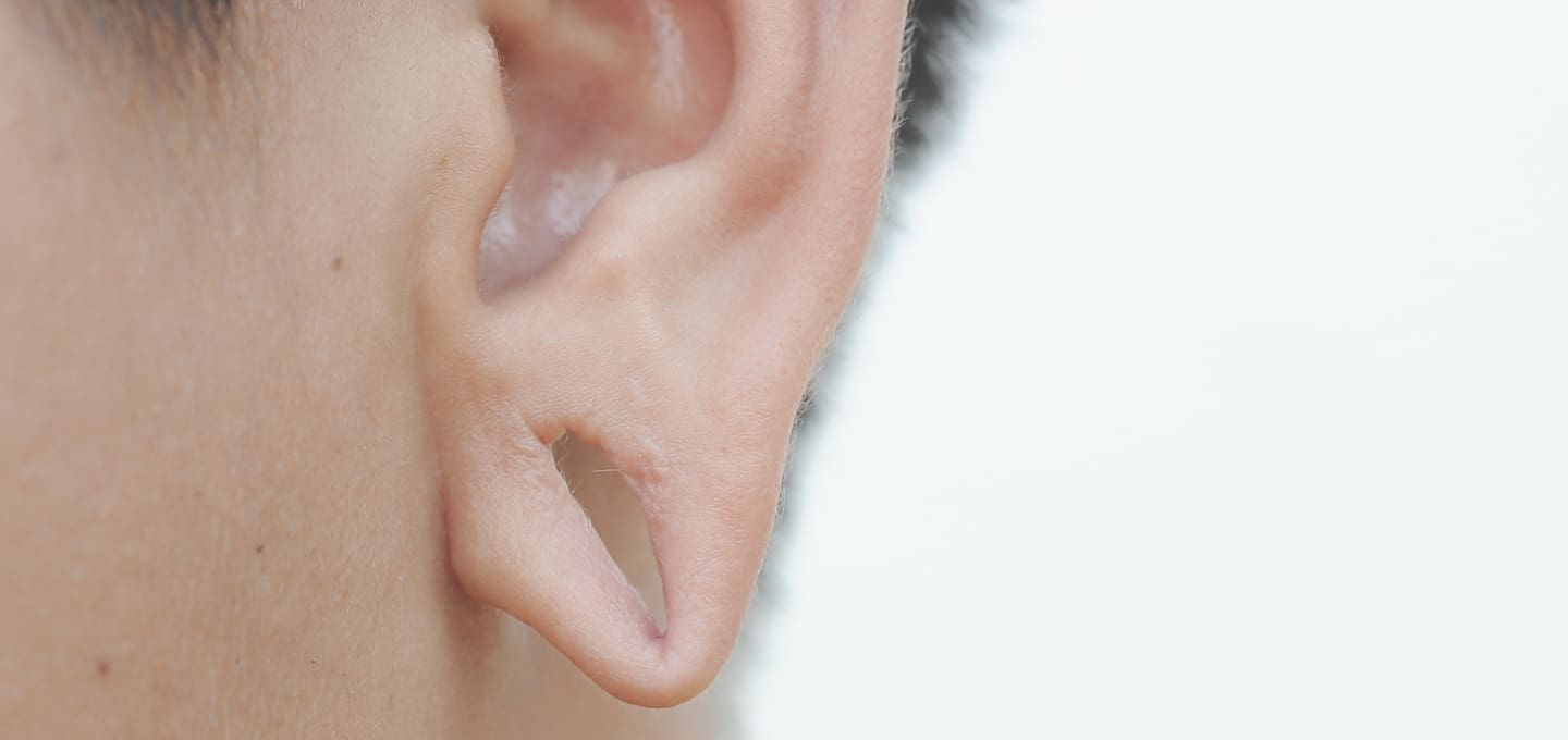 Split Earlobes | Conditions | The Day Clinic